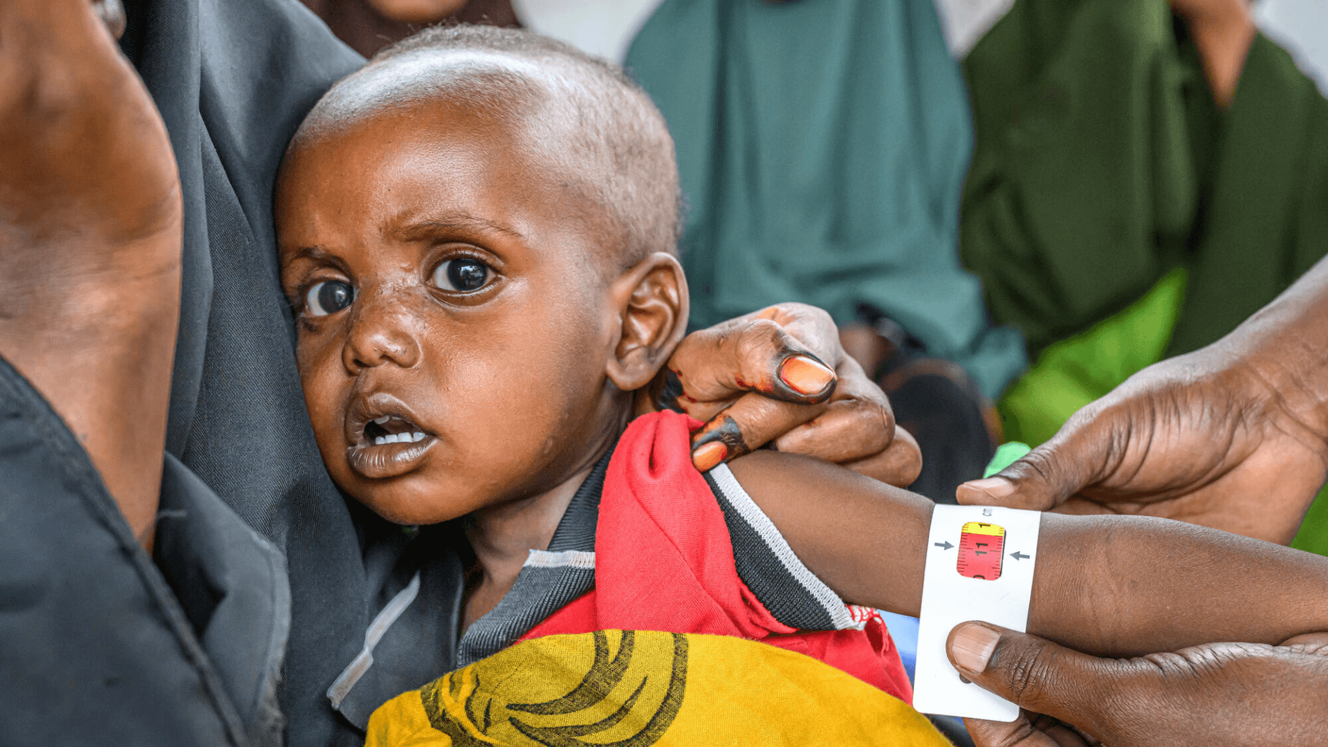 Muad (1,5) ernstig ondervoed | World Vision